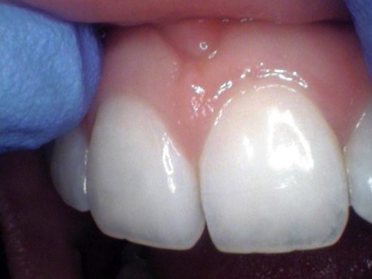 When Crest Whitestrips are a mistake. - Seasons of Smiles