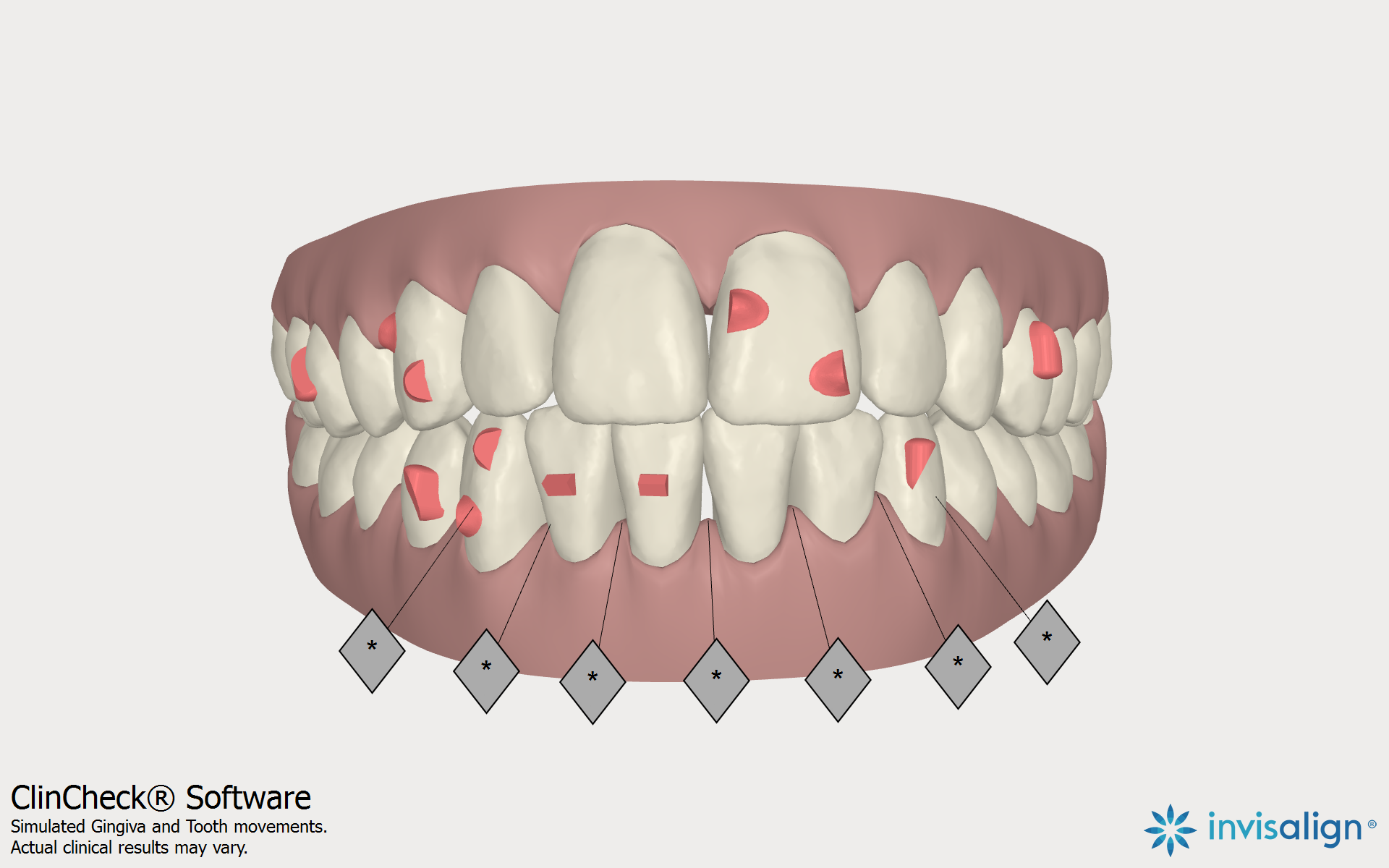 Invisalign Orthodontic Records and ClinCheck - Seasons of Smiles