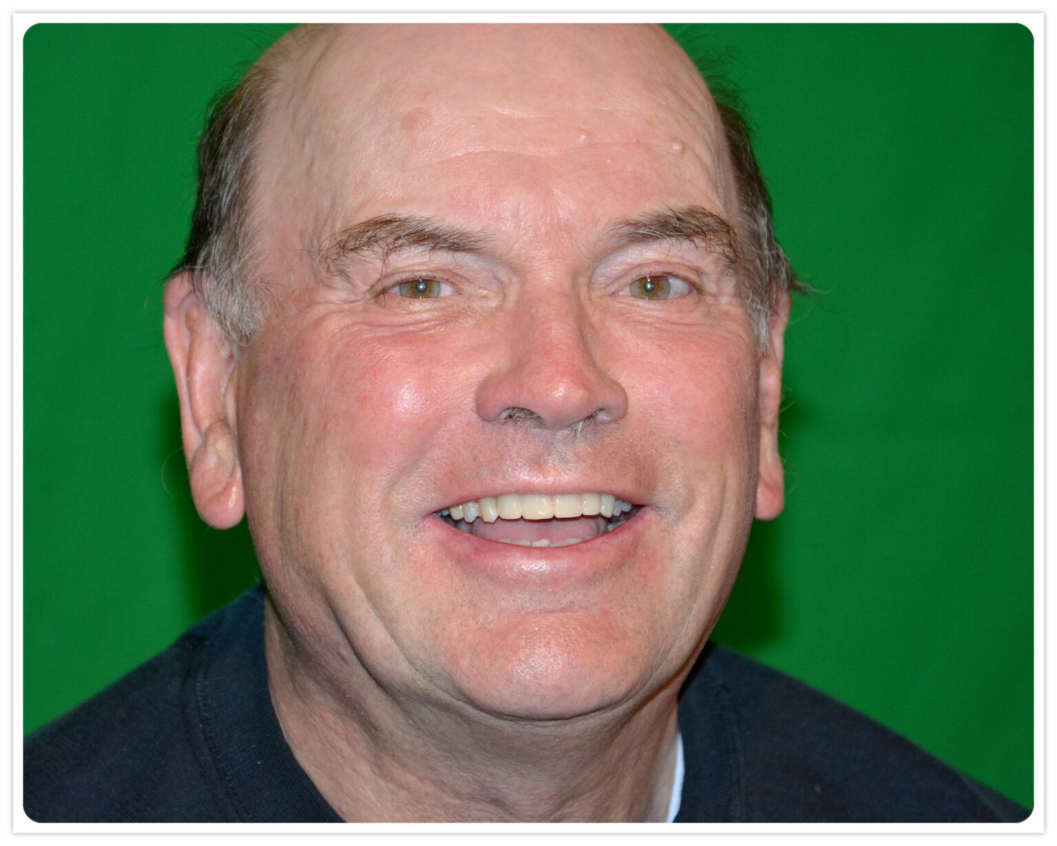 Bill Curtis has a Smile Makeover - Seasons of Smiles