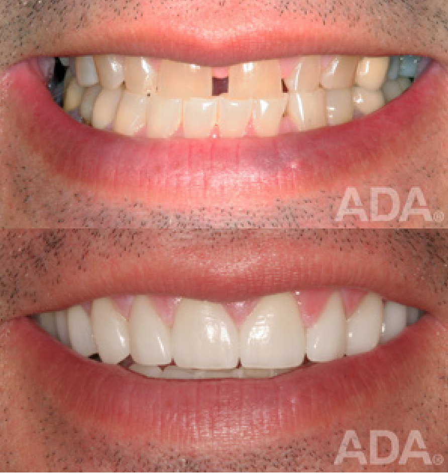 Improving your Smile - Seasons of Smiles