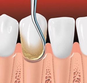Treating Periodontal Disease - Seasons of Smiles