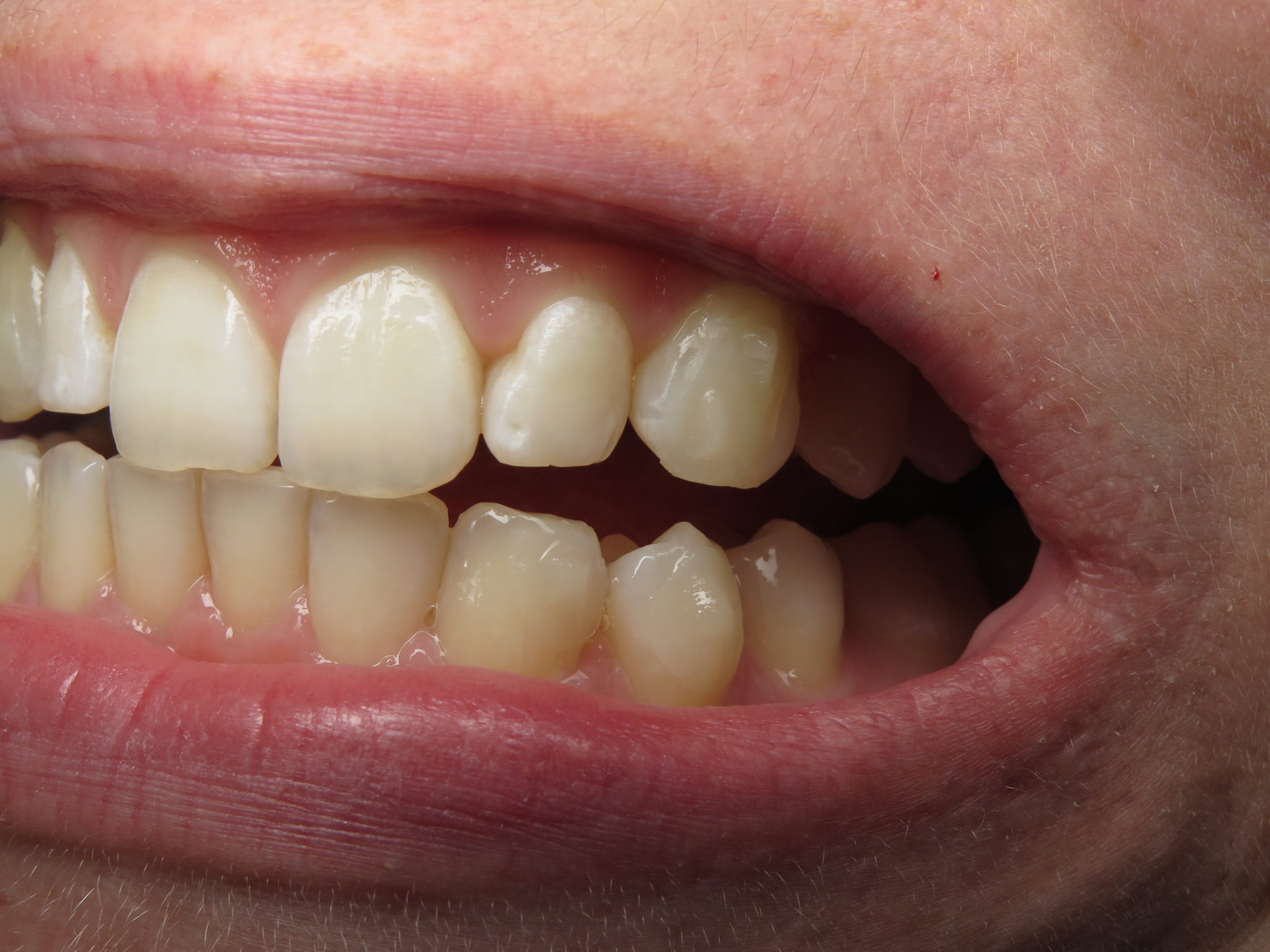 What do Invisalign buttons look like? • Seasons of Smiles Dental ...