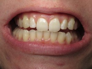 What do Invisalign buttons look like? • Seasons of Smiles Dental ...